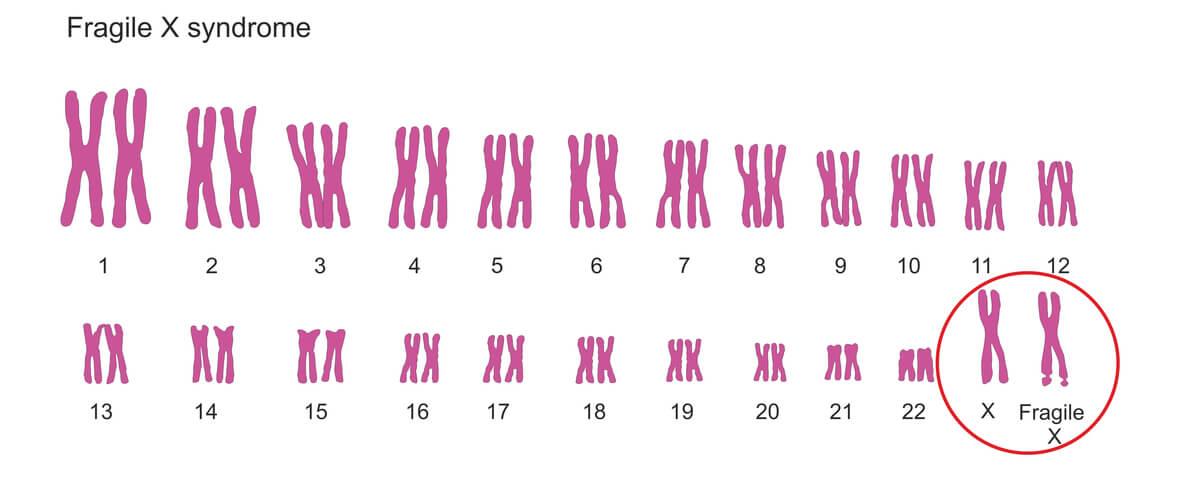 Síndrome X frágil: síntomas, causas y tratamientos - La Mente es ...