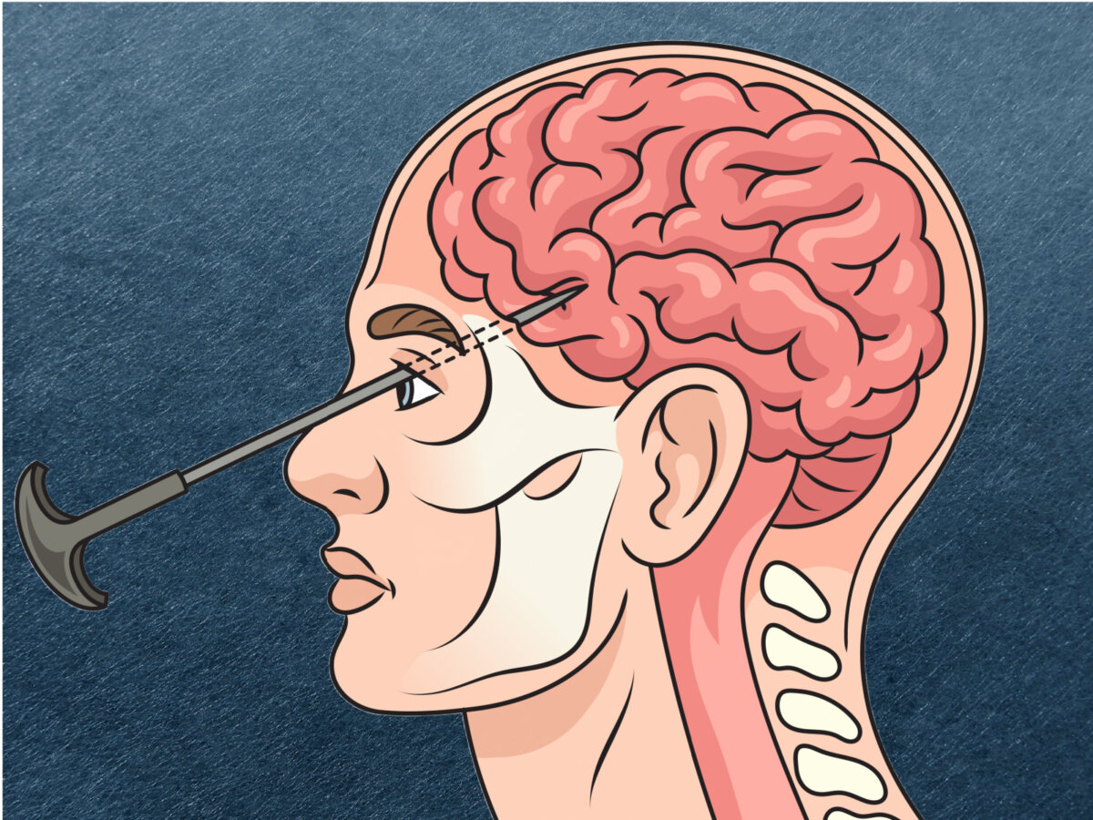 Lobotomía: qué es y cómo se realizaba